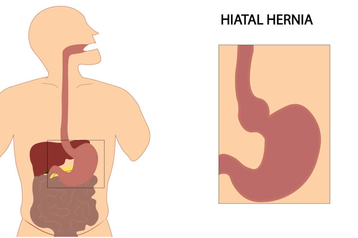 Ernia iatale: sintomi, rischi e soluzioni per una vita senza bruciore - Italia a Tavola